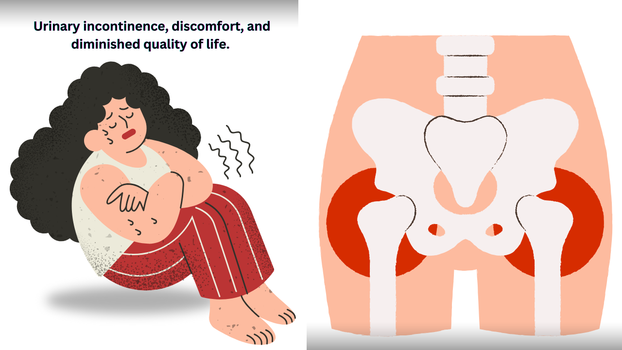 HIFEM® For Treatment Of Pelvic Floor Dysfunction